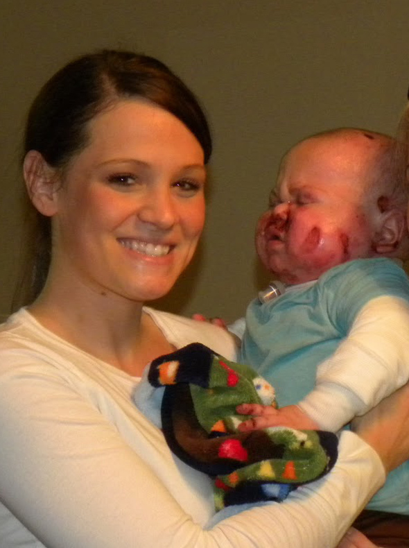 Toddler with rare skin disease still beating the odds